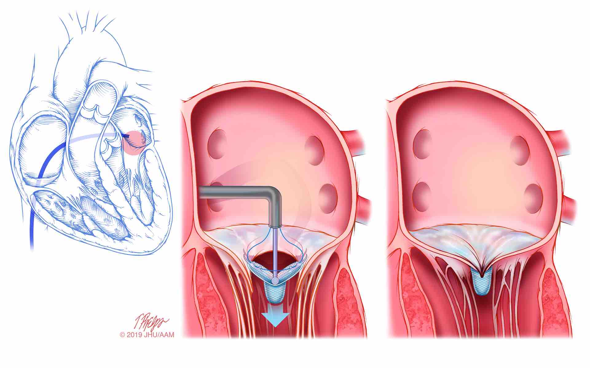 Mitral Valve Repair Medmonks Mitral Valve Mitral Valve Repair Images 