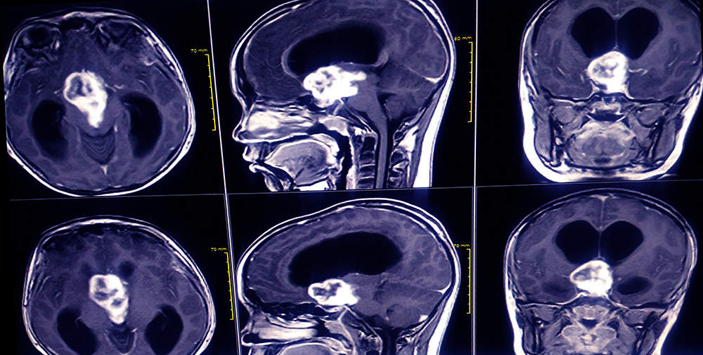 How A Routine Eye Exam Found A Brain Tumor And Saved A Patient s Life