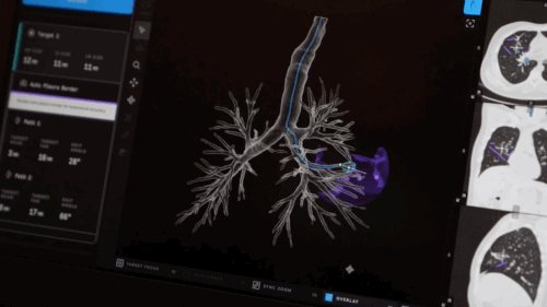 Robotic Bronchoscopy Offers Minimally Invasive, Earlier Lung Cancer ...