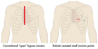 Best of both worlds: robotic-assisted bypass with angioplasty - UC Davis