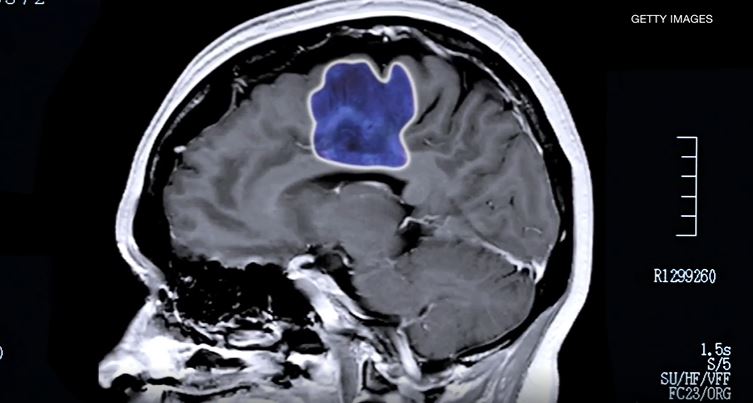 Glowing Tumors: How Fluorescence Helps Neurosurgeons Fight Brain Cancer ...