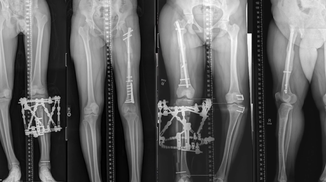 Post-Traumatic Limb Deformities in Children and Young Adults: A Global ...