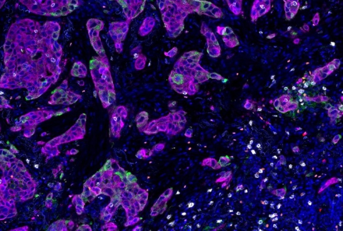 Type of KRAS mutation may guide more effective cancer treatments - UT ...