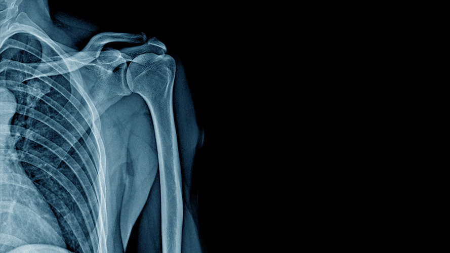 Administration of Tranexamic Acid During Total Shoulder Arthroplasty Is ...