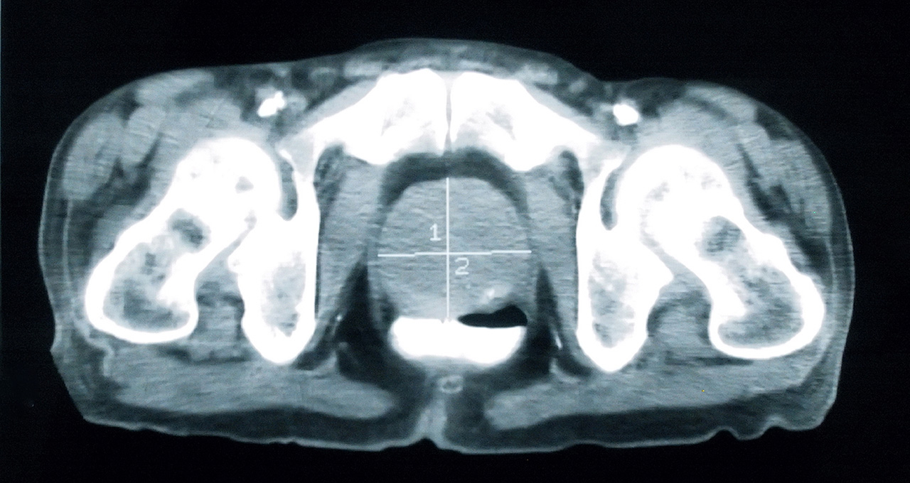 Prostate Cancer Surveillance, Treatment Disparities Among Urology ...