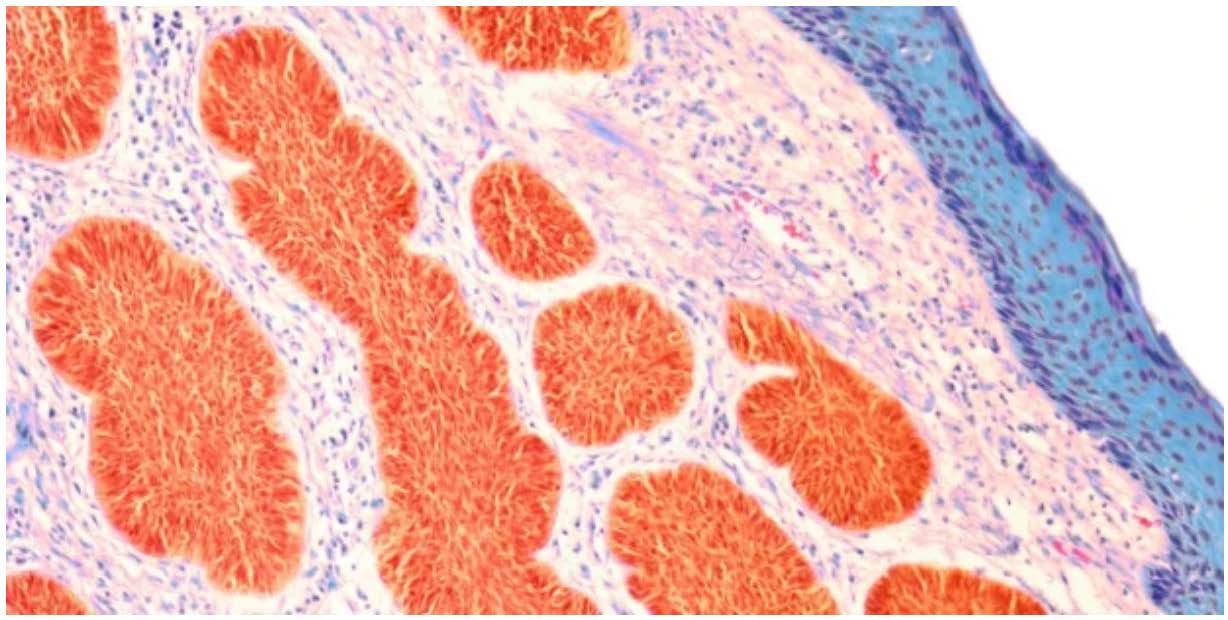Combining expertise with innovation - Multimodality skin cancer ...