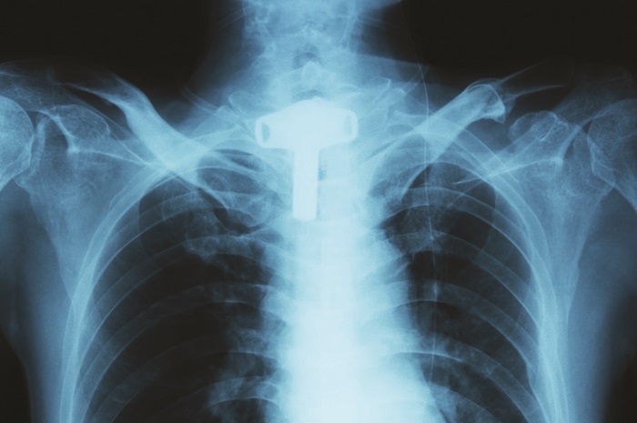 Tracheobronchial Malacia Referral Information - Temple Health