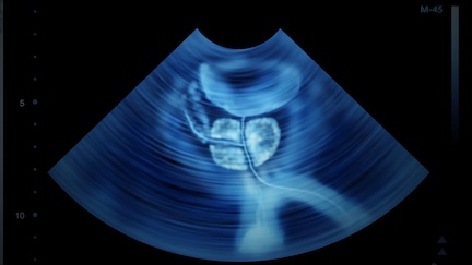 High Resolution Ultrasound HIGH RESOLUTION ULTRASOUND OF SCHWANNOMA OF