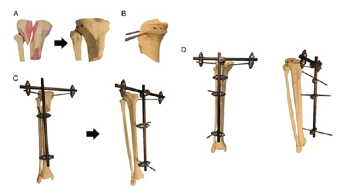 Novel T-bar technique for tibia fractures reduces infection risk and ...