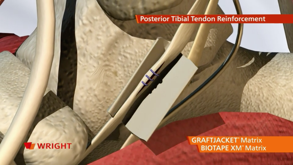 GRAFTJACKET™ Regenerative Tissue Matrix Posterior Tibial Tendon ...