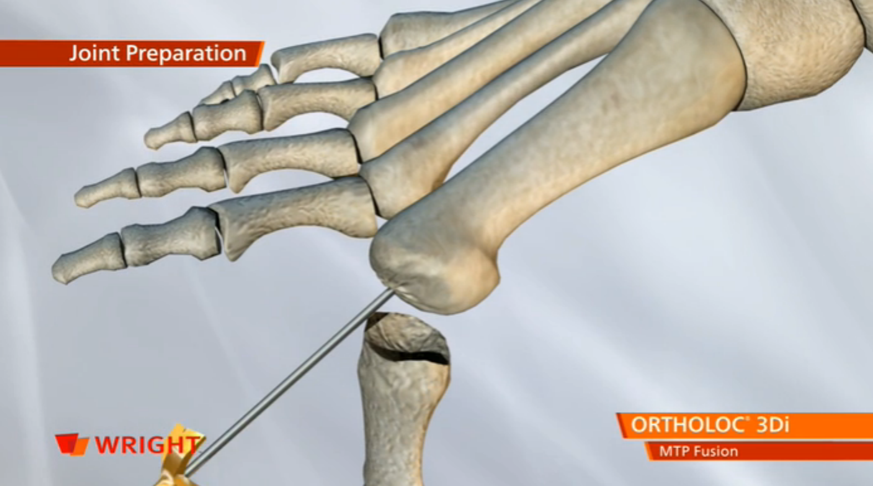 Feet Bone Fusing