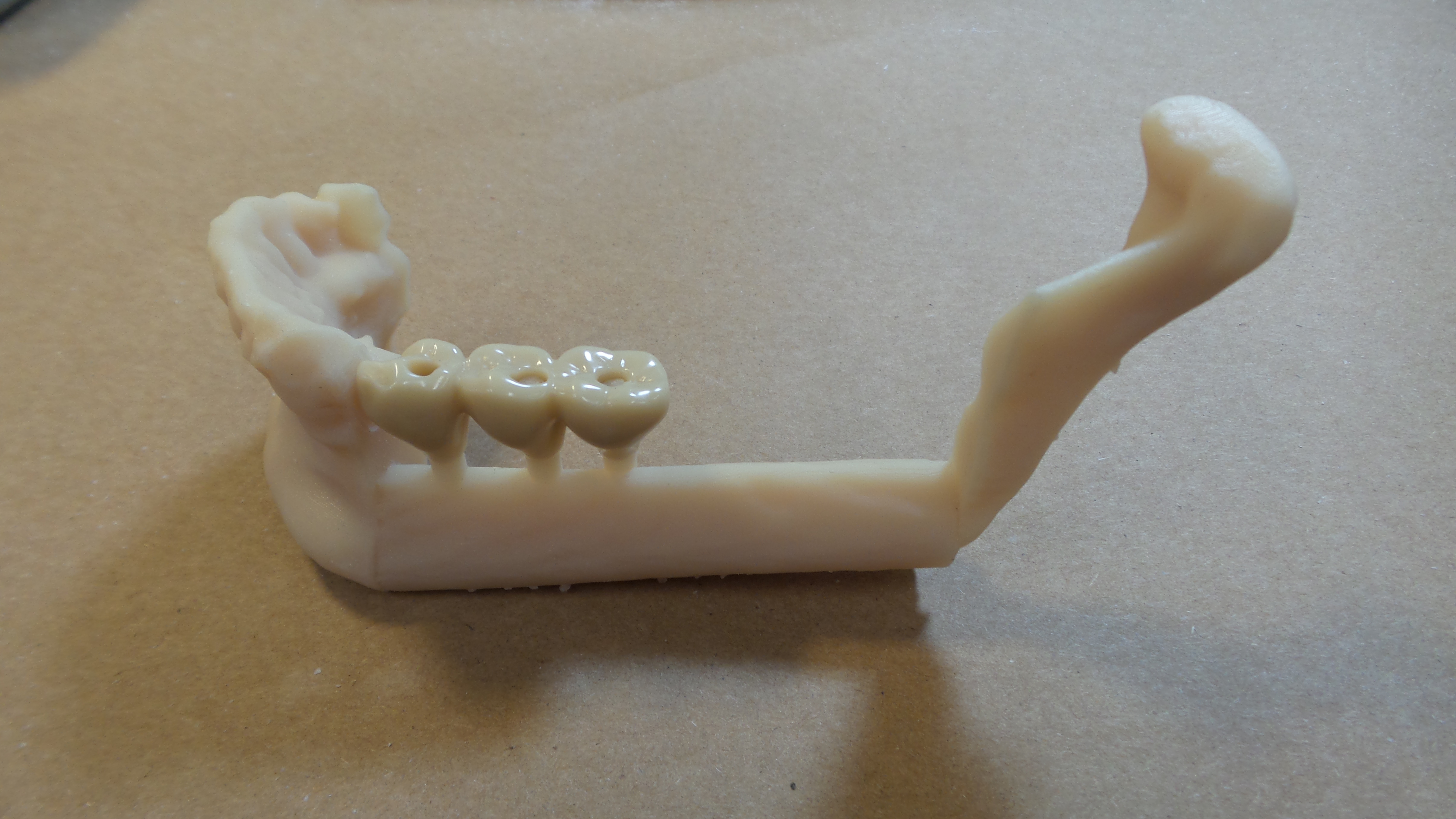 3d Printed Jaw Prosthetic