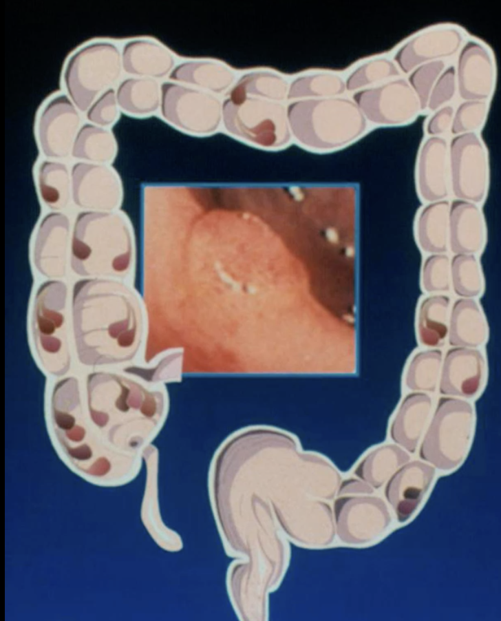 Colon Cancer Syndromes - Physician's Channel - Mount Sinai New York