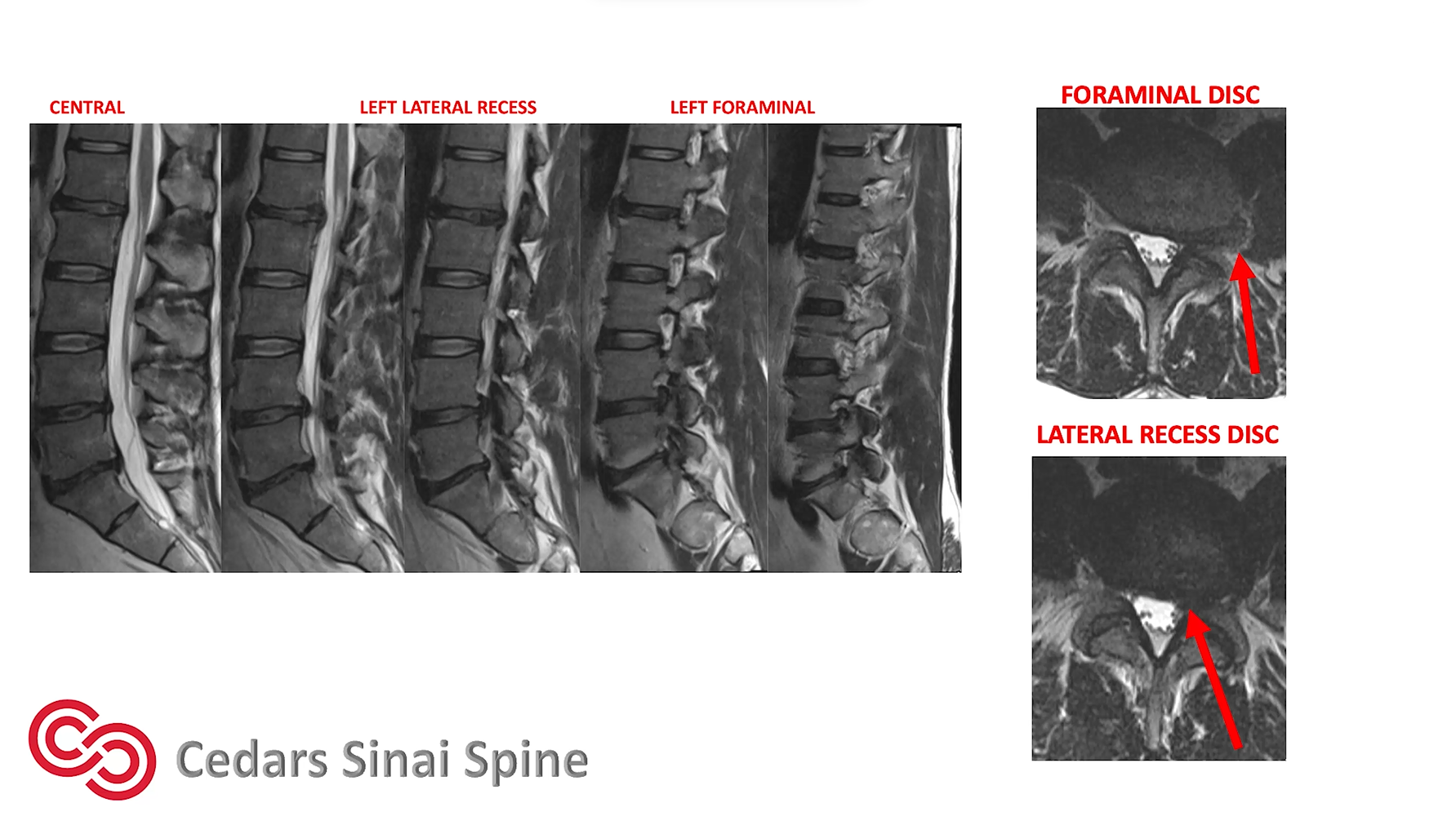 Surgical Case Video: Tubular Decompression Surgery | Conexiant
