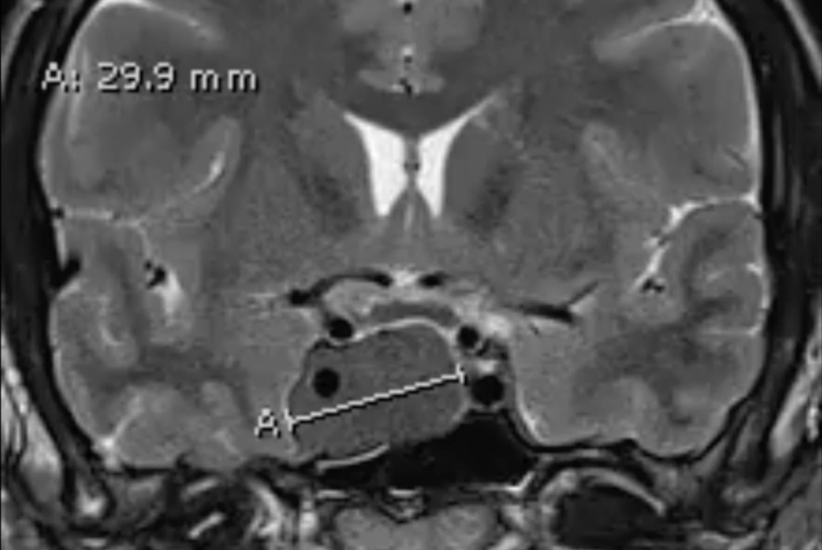 Team approach to Transsphenoidal Surgery - Sentara