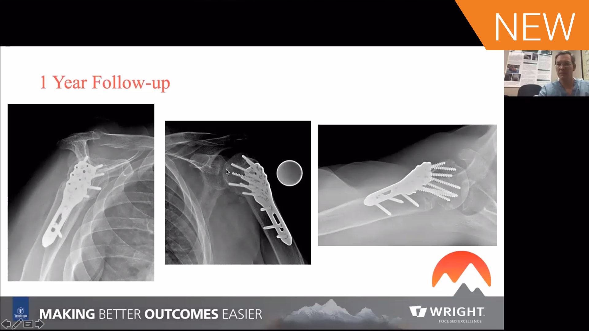 Humerus Fracture Recovery
